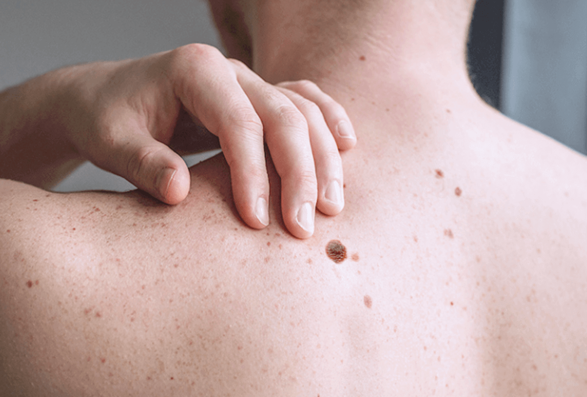 Kako prepoznati melanom | Poliklinika BINOVA