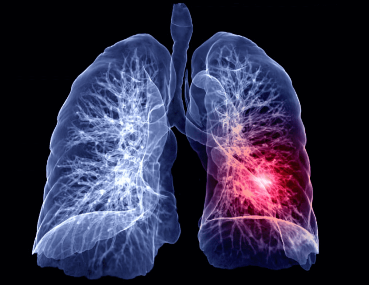 Embolija pluća: simptomi, dijagnoza i liječenje